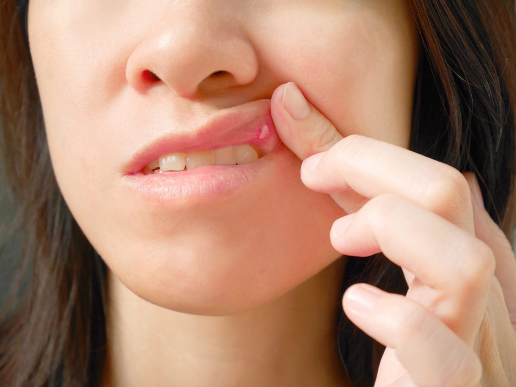 Mouth Sores and Infections- Causes, Symptoms, Treatment
